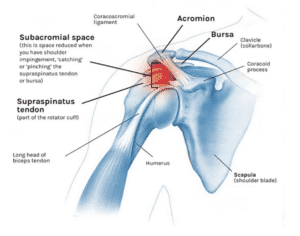 Shoulder Bursitis - Fighting Fit Physiotherapy Nerang Gold Coast